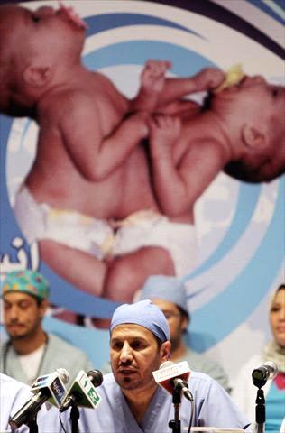 Jordanian Conjoined twins successfully separated | Editor's Choice ...